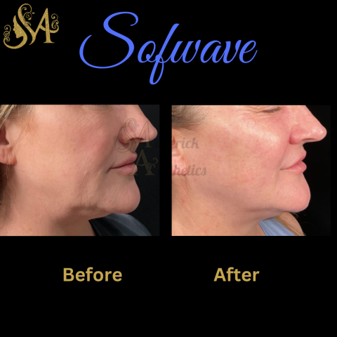 Sofwave - Maverick Aesthetics